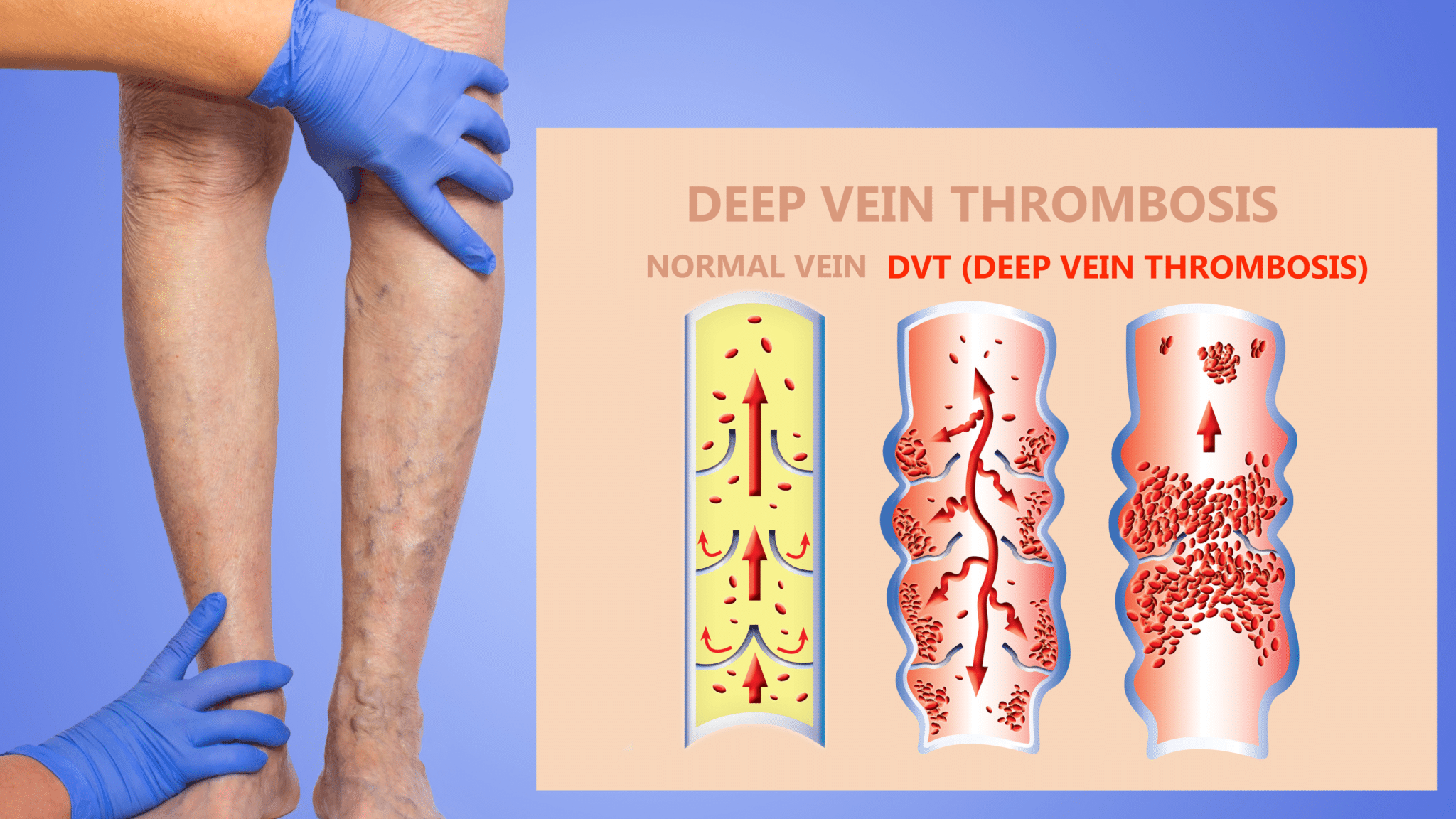 Deep Vein Thrombosis Symptoms and Risk