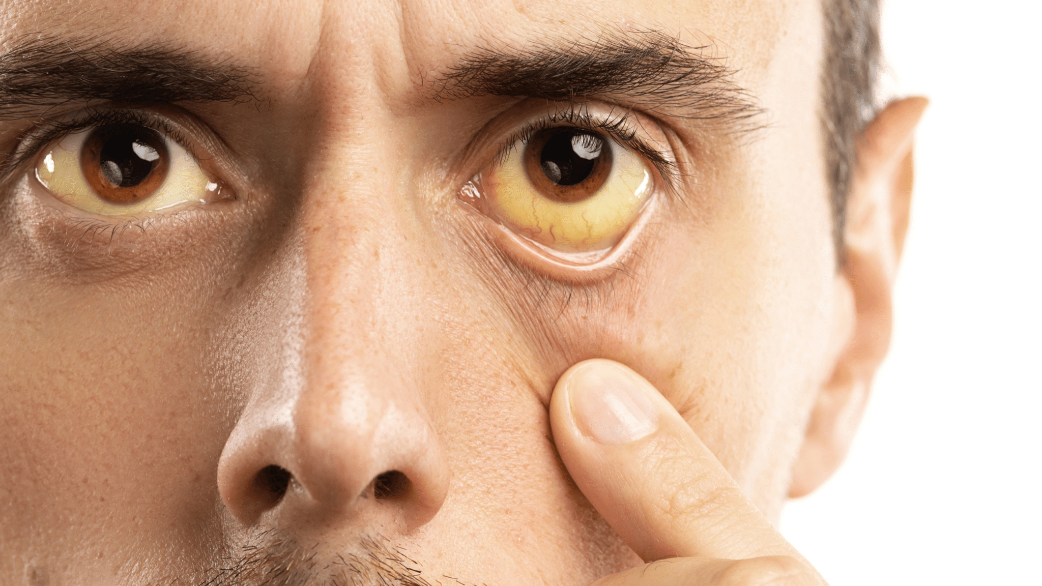 Alcoholic Liver Disease Warning Signs